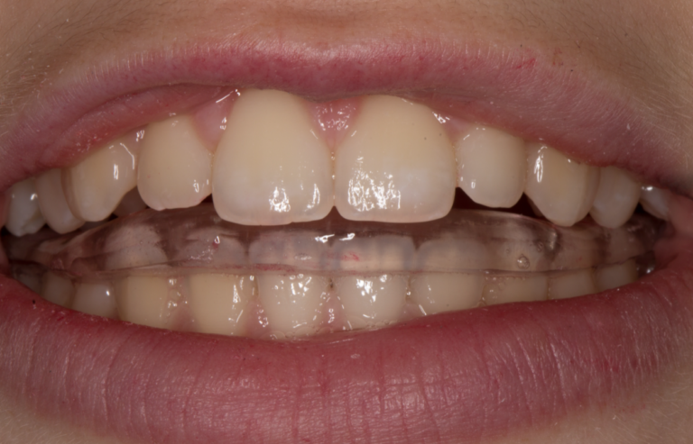 What’s bite got to do with it? - Advance Physical Therapy