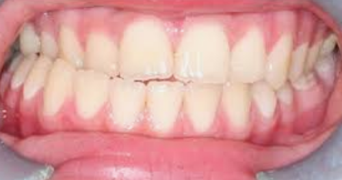 What’s bite got to do with it? - Advance Physical Therapy